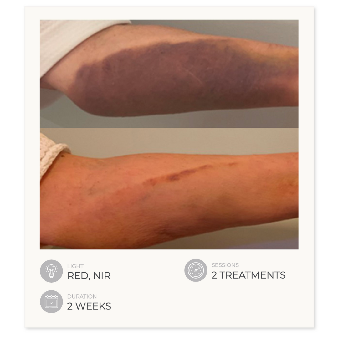 Dermalux Flex MD - Medical Grade LED Light Therapy